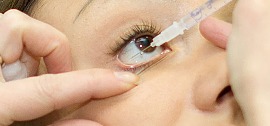 Retinal Injections – Navkar Eye and Smile